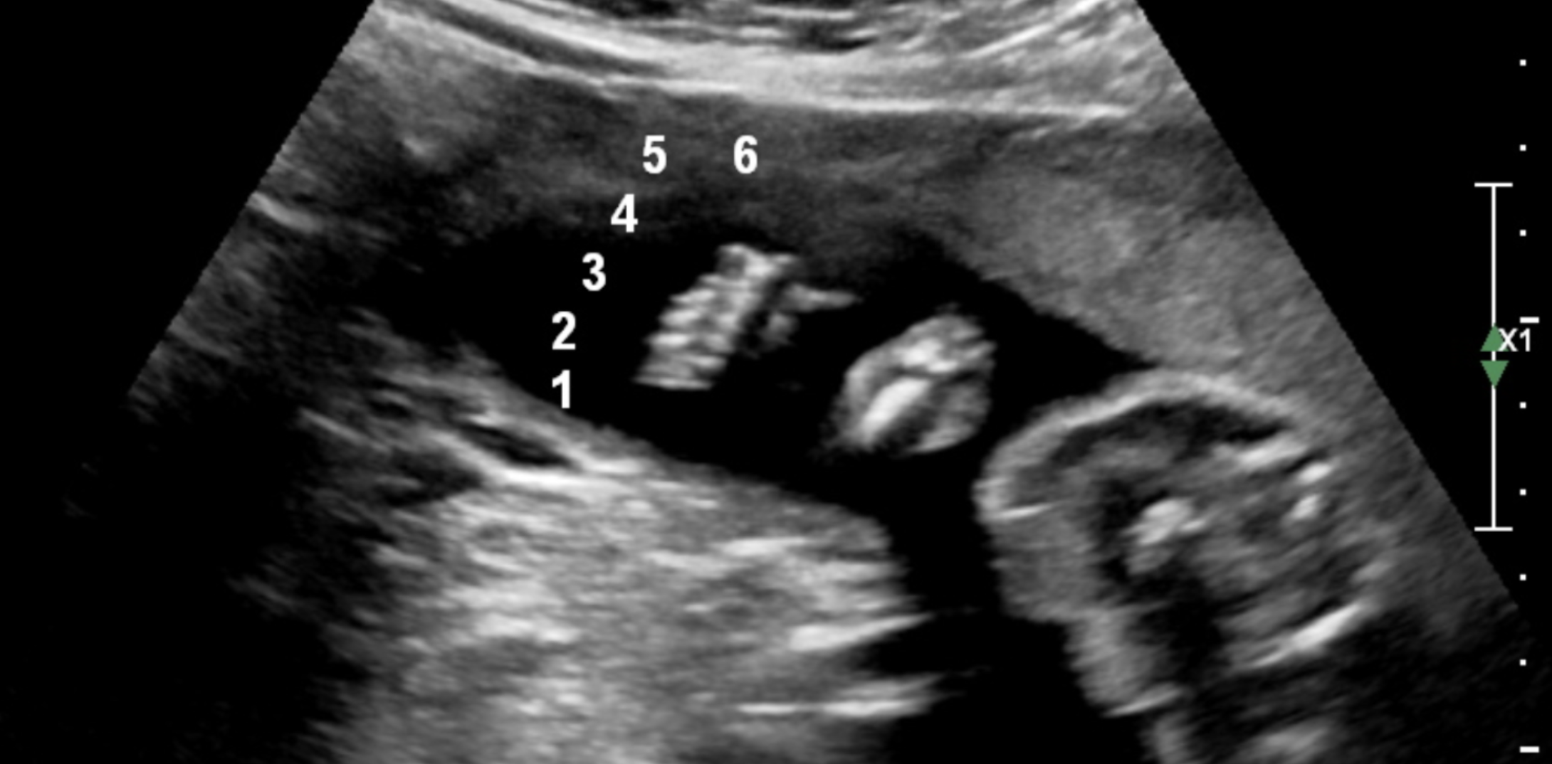 Scan Of The Week 6 Toes During A 20 Week Scan Ultrasound Scan Dublin